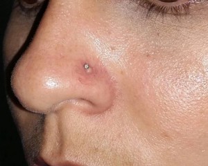 Queloide no nariz: Como tirar a bolinha que surge no piercing?